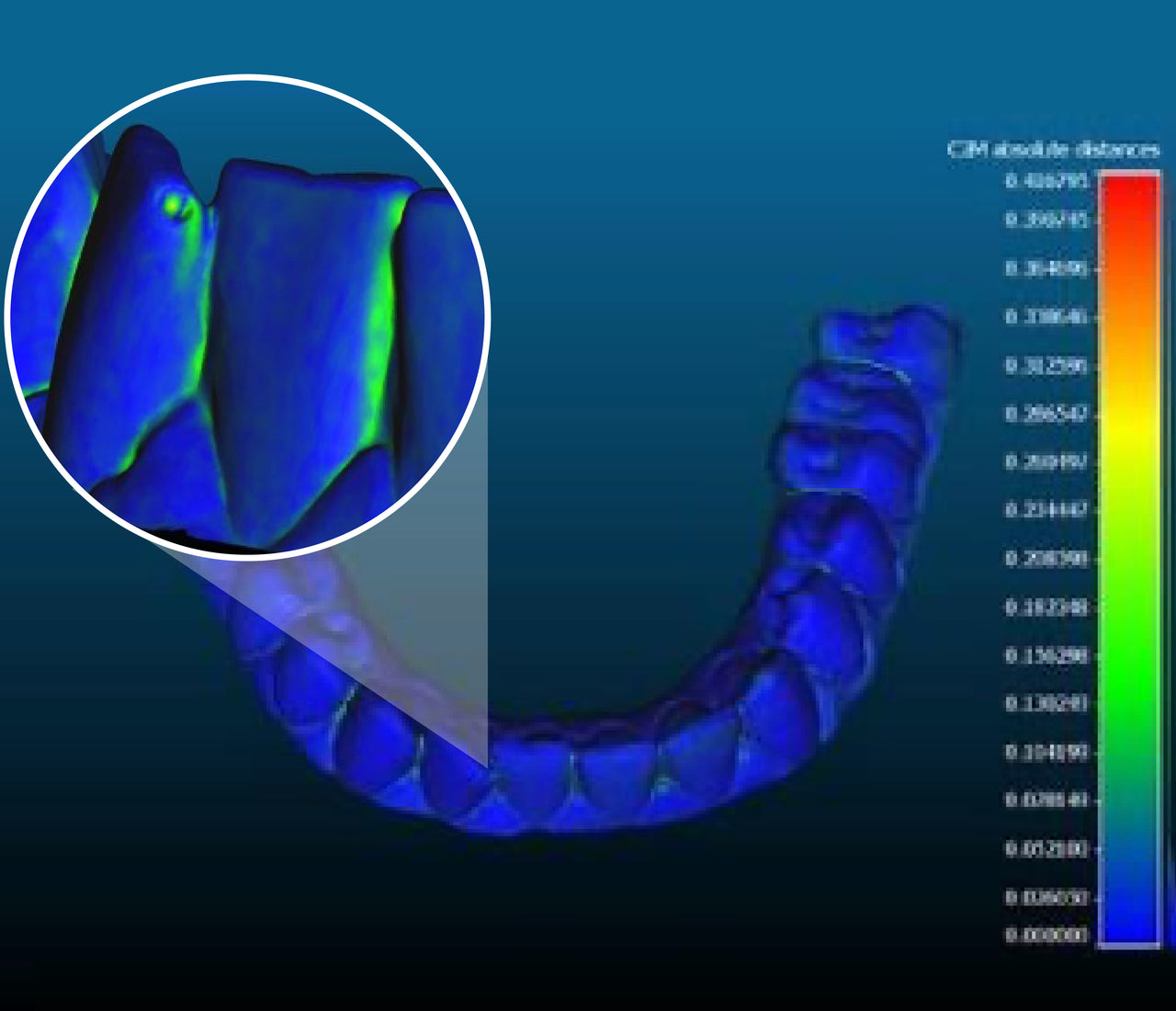 Read before buying an Intraoral Scanner for Dental 3D Printing